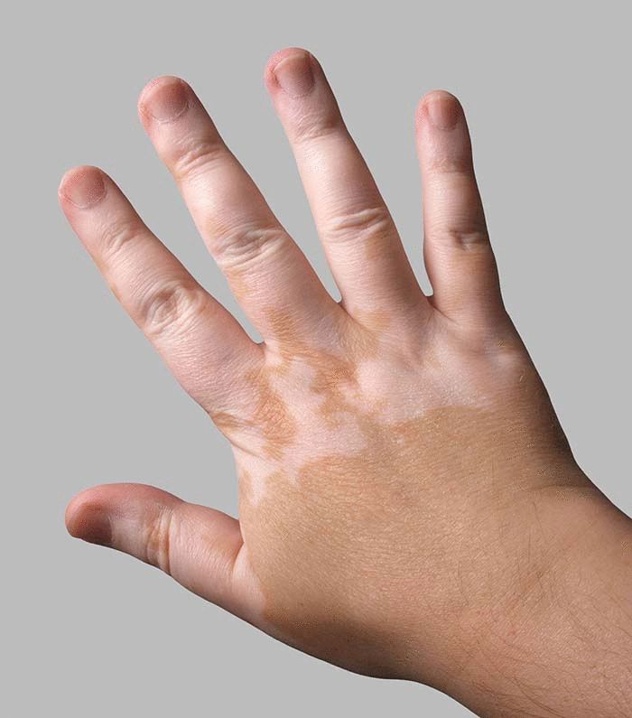 View 10 Types Of Vitiligo Skin Disease Churchreesz