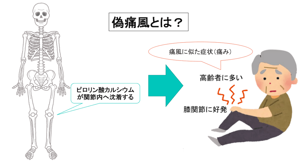 偽痛風とは？痛風との違いや原因、治療を解説