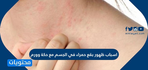 اسباب ظهور بقع حمراء في الجسم مع حكة وورم وكيفية علاجها موقع محتويات