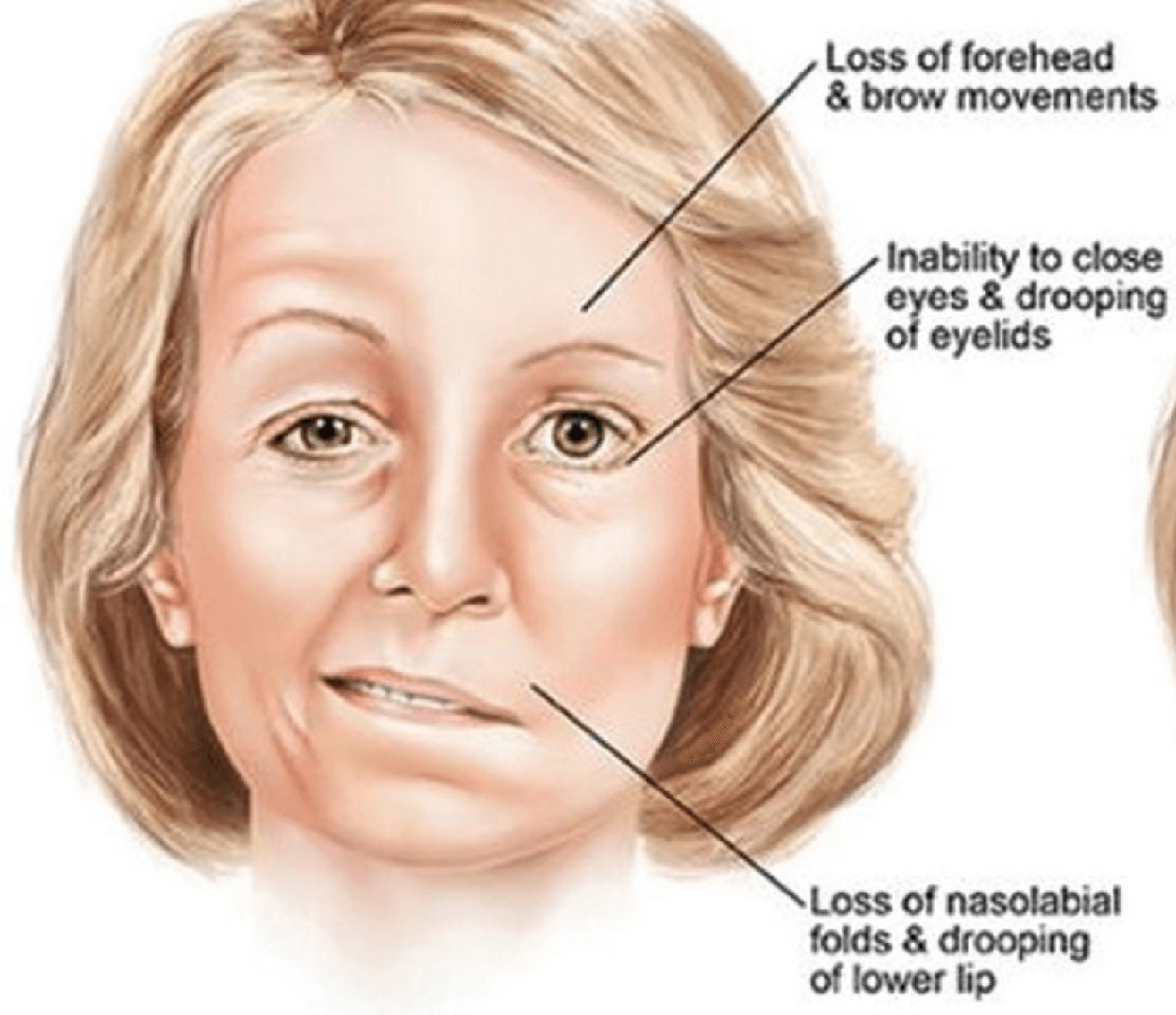 Understanding Bells Palsy Causes Prognosis And Treatment Options