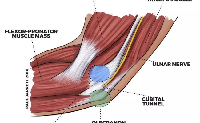 Cubital Tunnel Syndrome Inflamed Ulnar Nerve Medical Vector Bilarasa