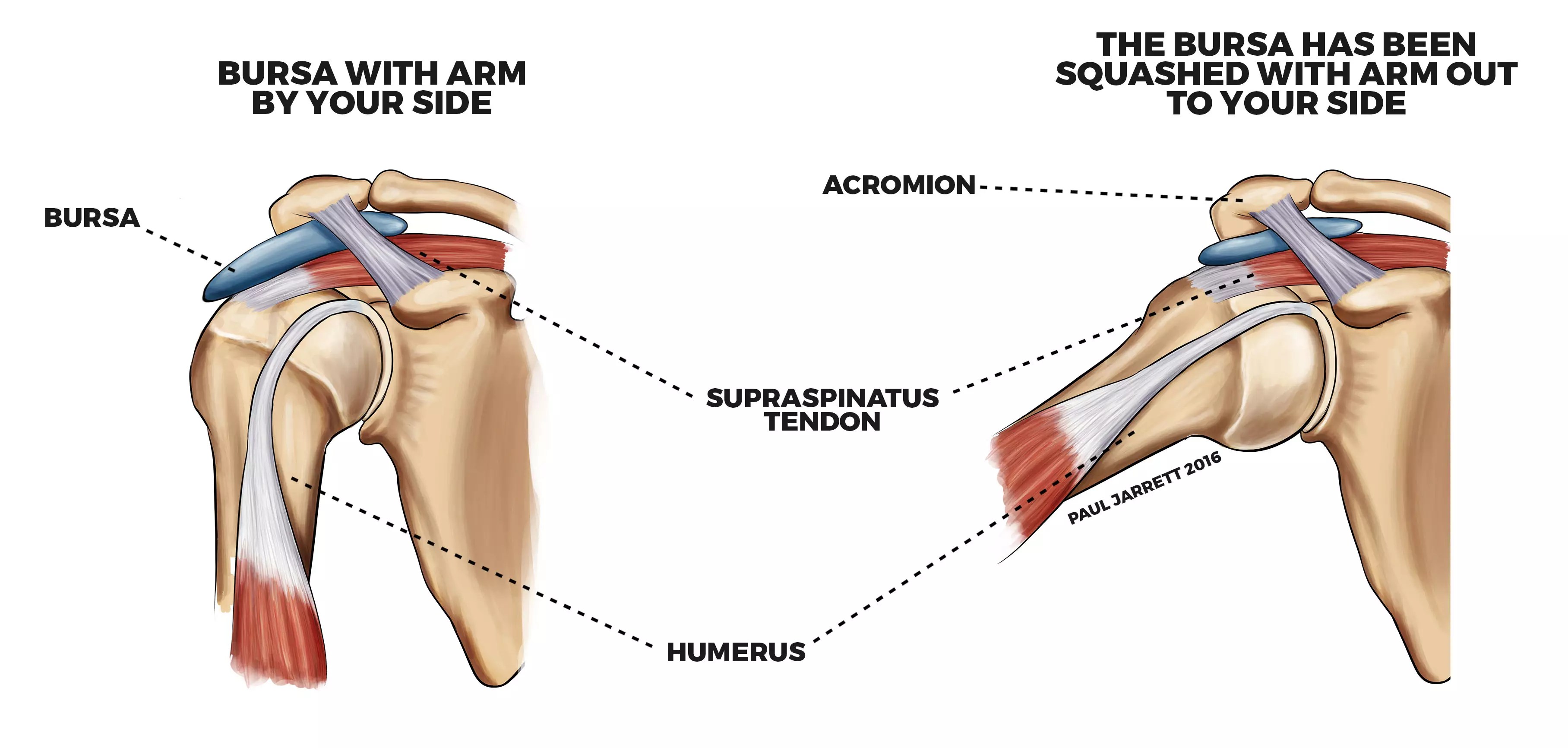 Shoulder Impingement Syndrome Bursitis Or Tendonitis Orthopedists