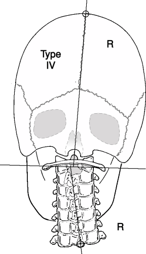 General Types Of Upper Cervical Subluxations Musculoskeletal Key