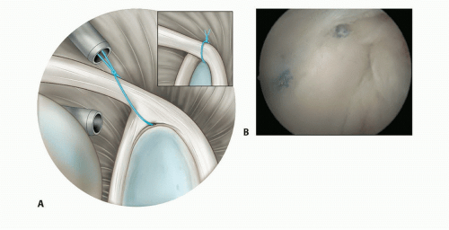 Scapulothoracic Arthroscopy Musculoskeletal Key