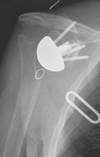 Glenoid Component Musculoskeletal Key