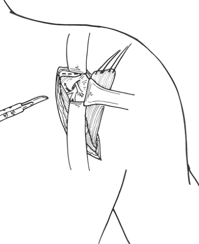 Suprascapular Nerve Decompression Musculoskeletal Key