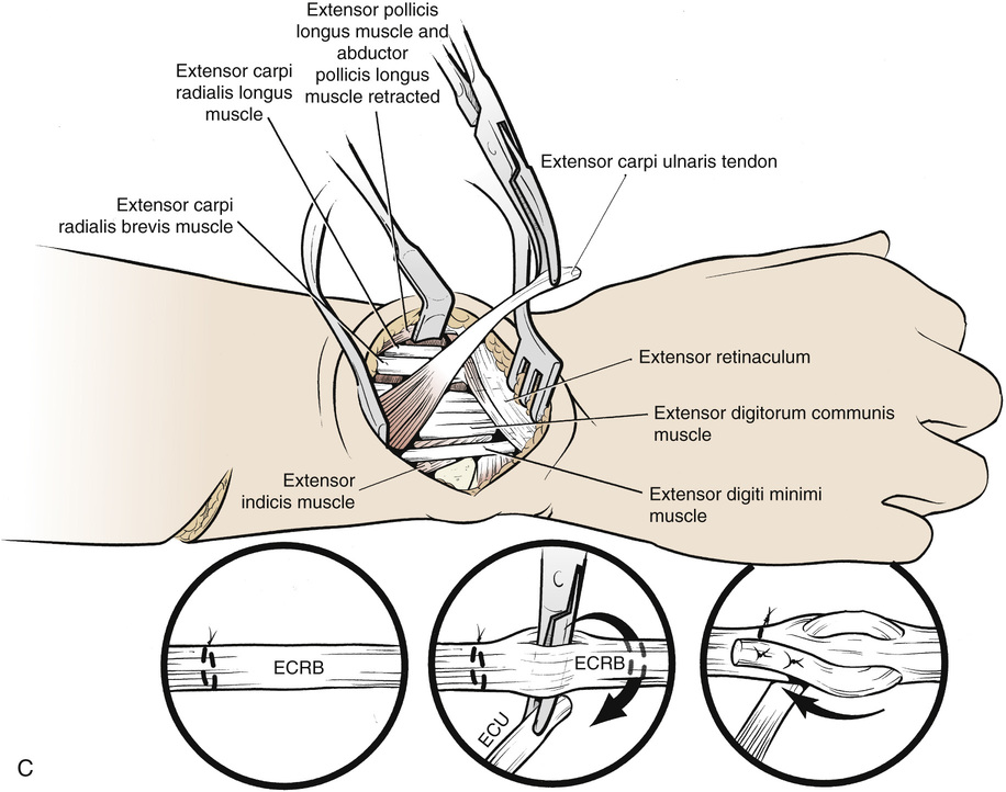 20 Split Anterior Tibialis Tendon Transfer Musculoskeletal Key