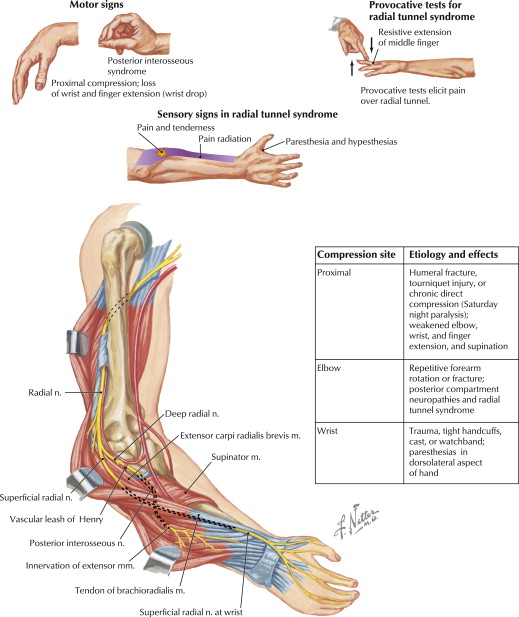 Diagnosis And Treatment Of Work Related Proximal Median And Radial