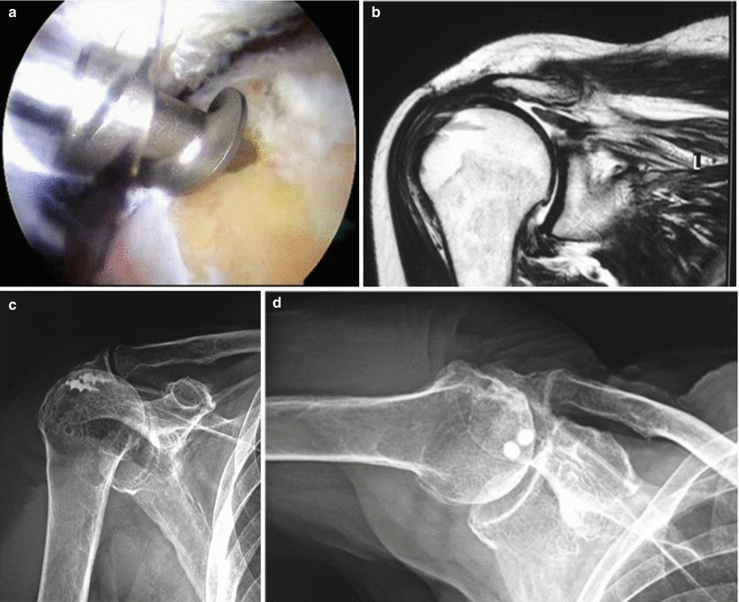 Of Arthroscopic Rotator Cuff Repair Musculoskeletal Key