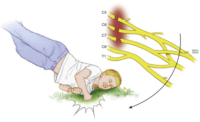 Traumatic Brachial Plexus Injury Musculoskeletal Key