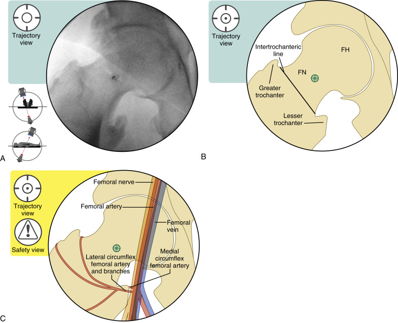 Anatomic Landmark Guided Hip Aspiration In The Diagno