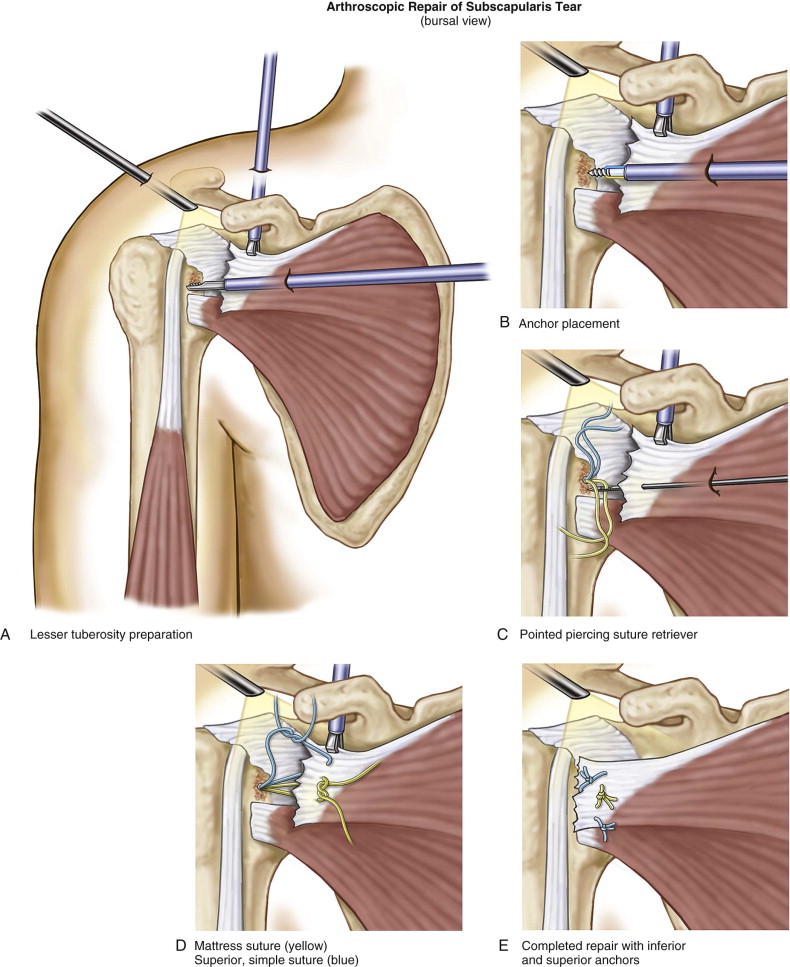 Subscapularis Injury Musculoskeletal Key