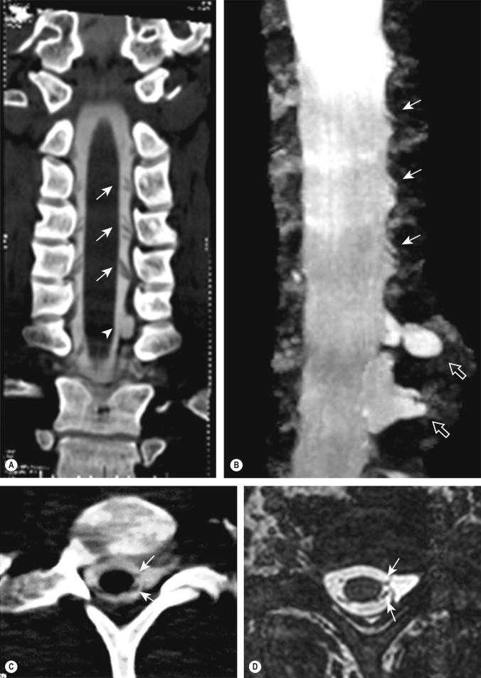 Radiographic Assessment Of Adult Brachial Plexus Injuries