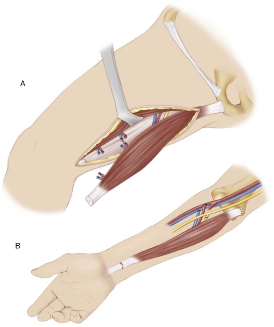 Nerve Transfers Musculoskeletal Key