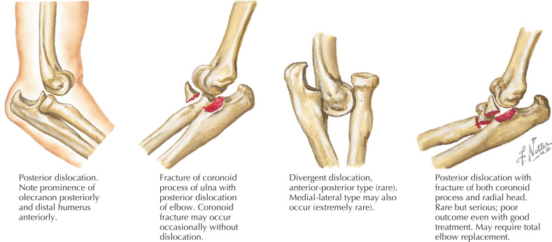 Elbow Injuries Musculoskeletal Key