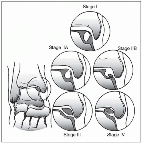 Osteochondral Defect Classification Mri