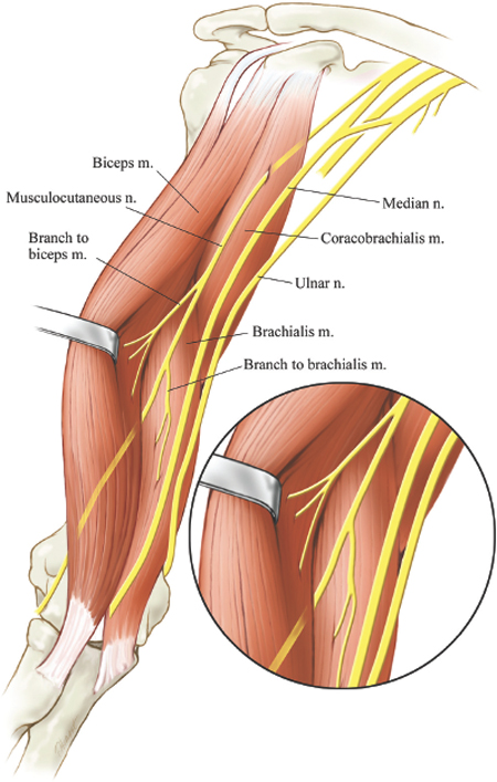 Nerve Transfer For Restoration Of Elbow Flexion The Modified Oberlin