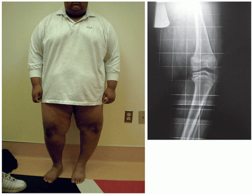 Differences Between Pediatric And Adult Musculoskeletal Systems