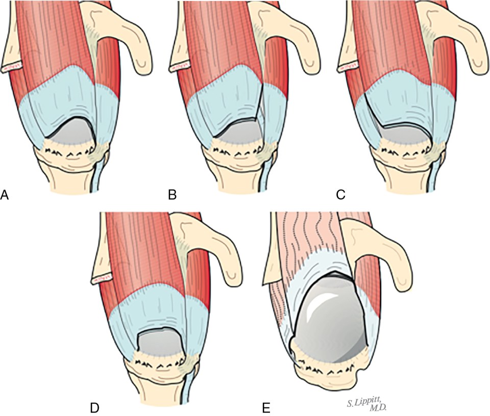 Rotator Cuff Repair Tear Classification Operative Techniques And