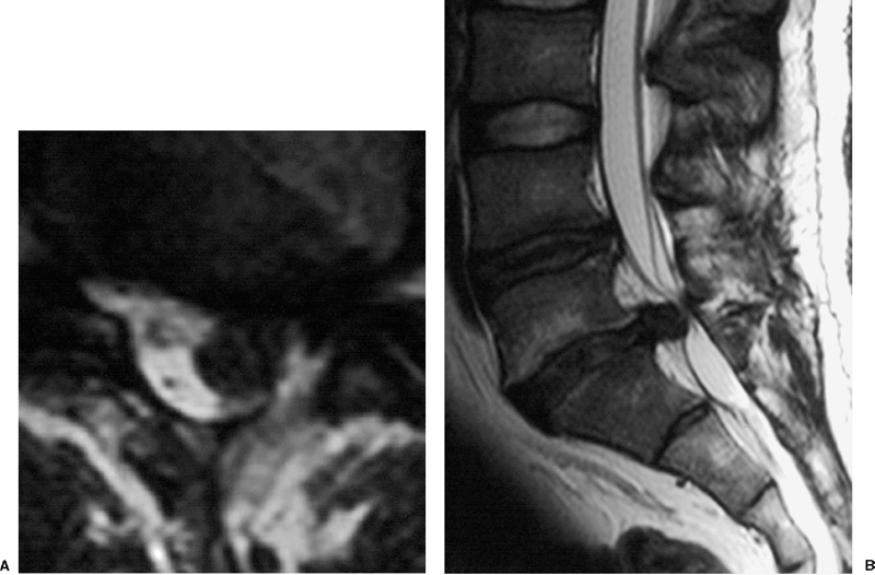 Acute Intervention For Cervical Thoracic And Lumbar Spinal Disk