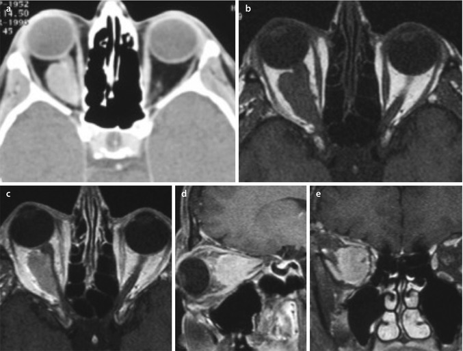 Tumors Of The Skull Base Neupsy Key