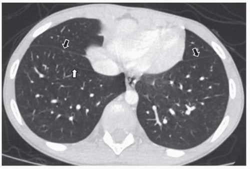 Lung Neupsy Key