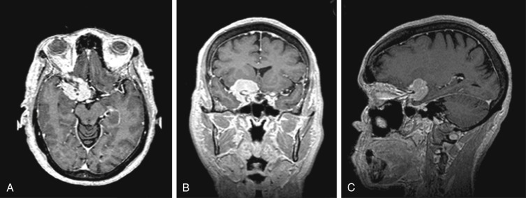 Sphenoid Wing Meningiomas Neupsy Key