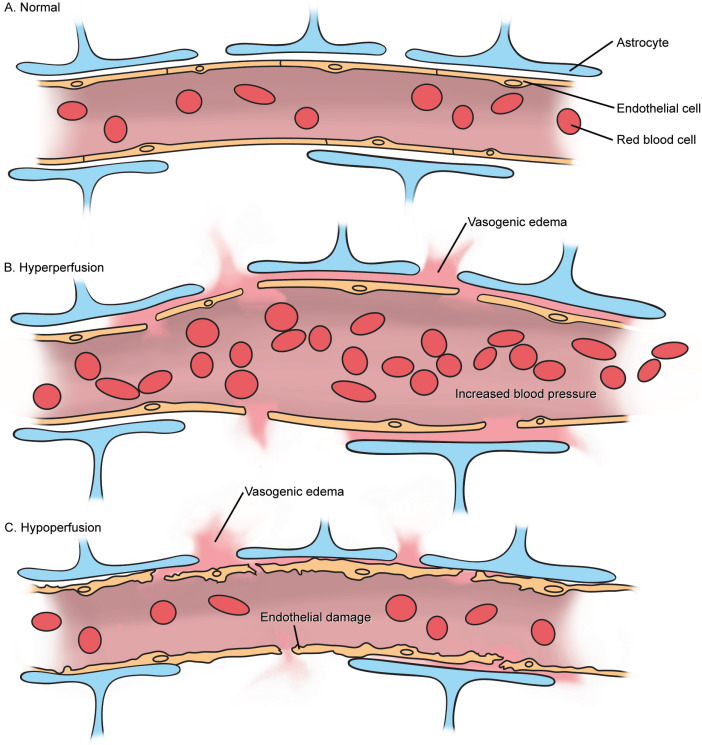 Posterior Reversible Encephalopathy Syndrome Neupsy Key