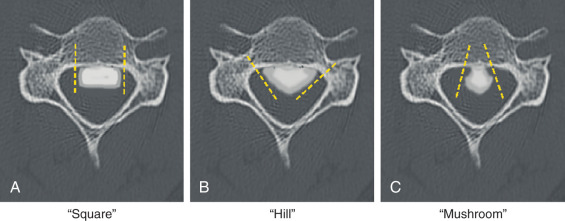 Ossification Of The Posterior Longitudinal Ligament Neupsy Key