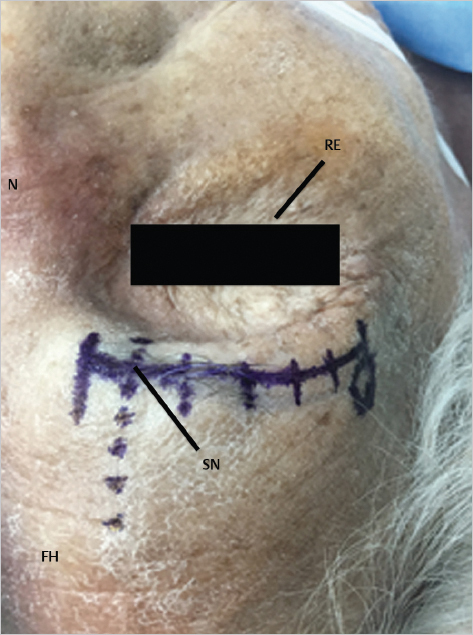 Supraorbital Approach Neupsy Key