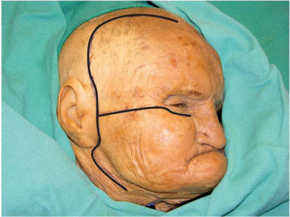 3 Transfacial Transmaxillary Approach Neupsy Key