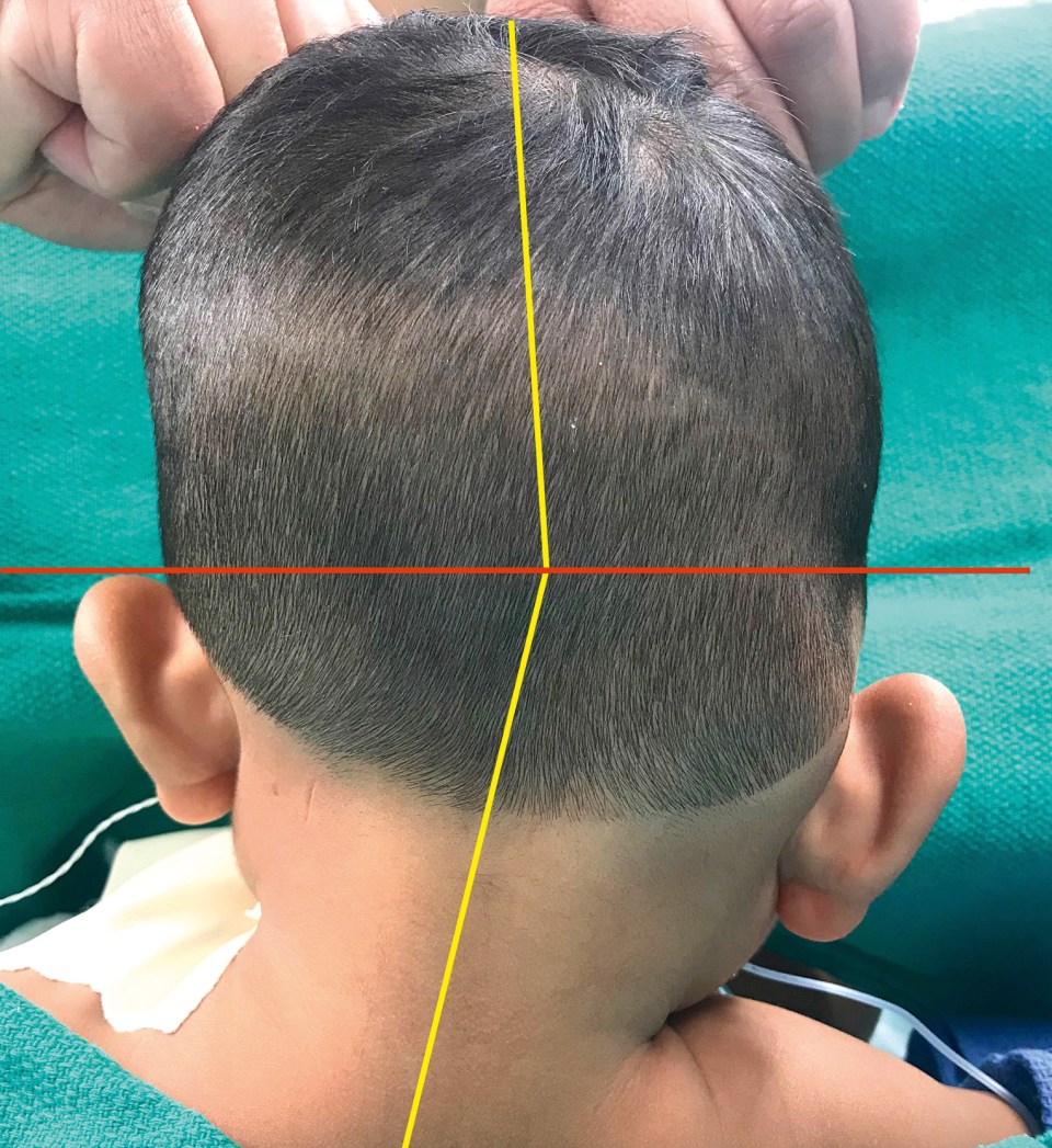 Lambdoid Craniosynostosis Neupsy Key