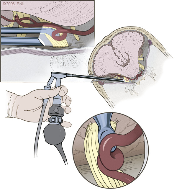 Neurosurgical Interventions Nurse Key