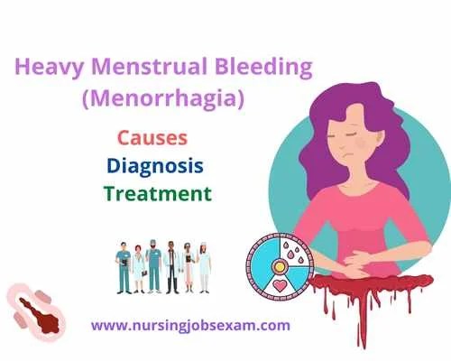 Heavy Menstrual Bleeding Menorrhagia Causes Diagnosis Treatment By