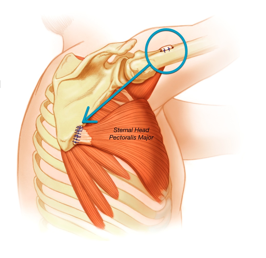 Pectoralis Major Transfer Shoulder And Elbow