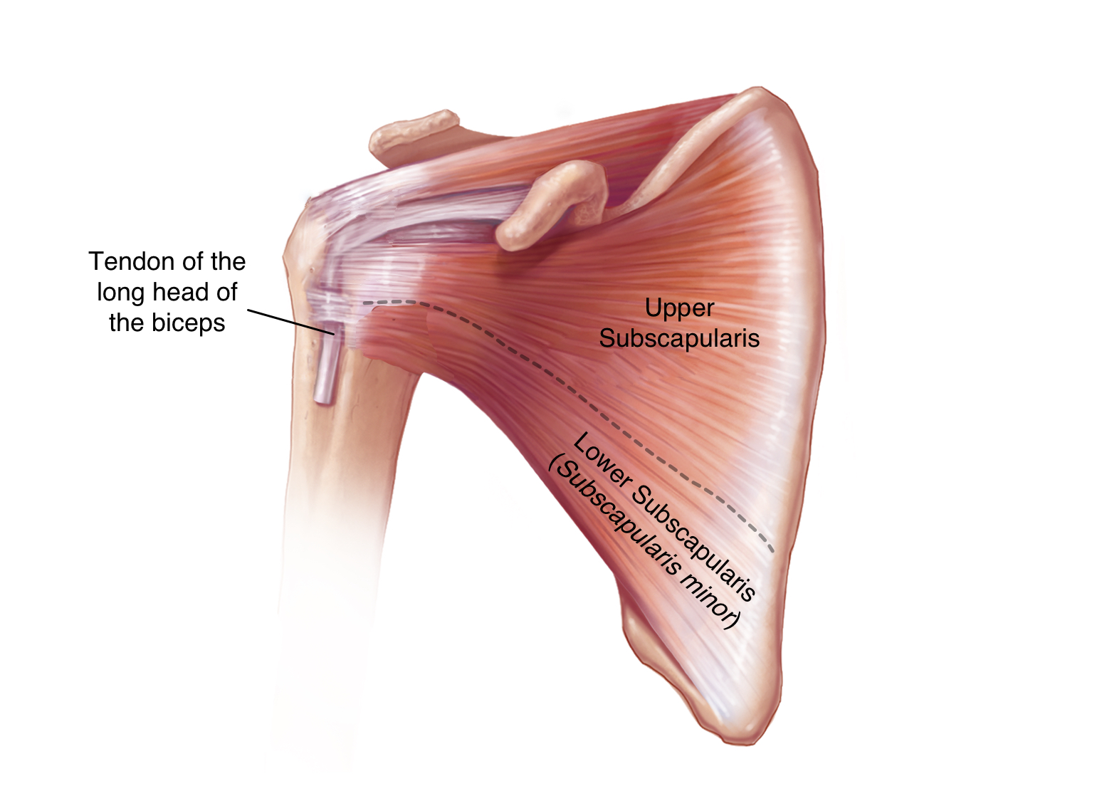 Tears Of The Subscapularis Hidden And Forgotten No More Shoulder