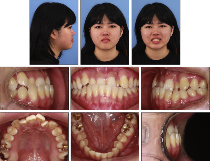 Nonsurgical Treatment Of An Adult With A Skeletal Class Iii