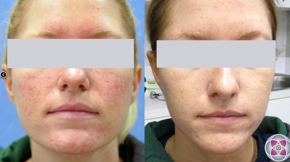 Rosacea Before And After