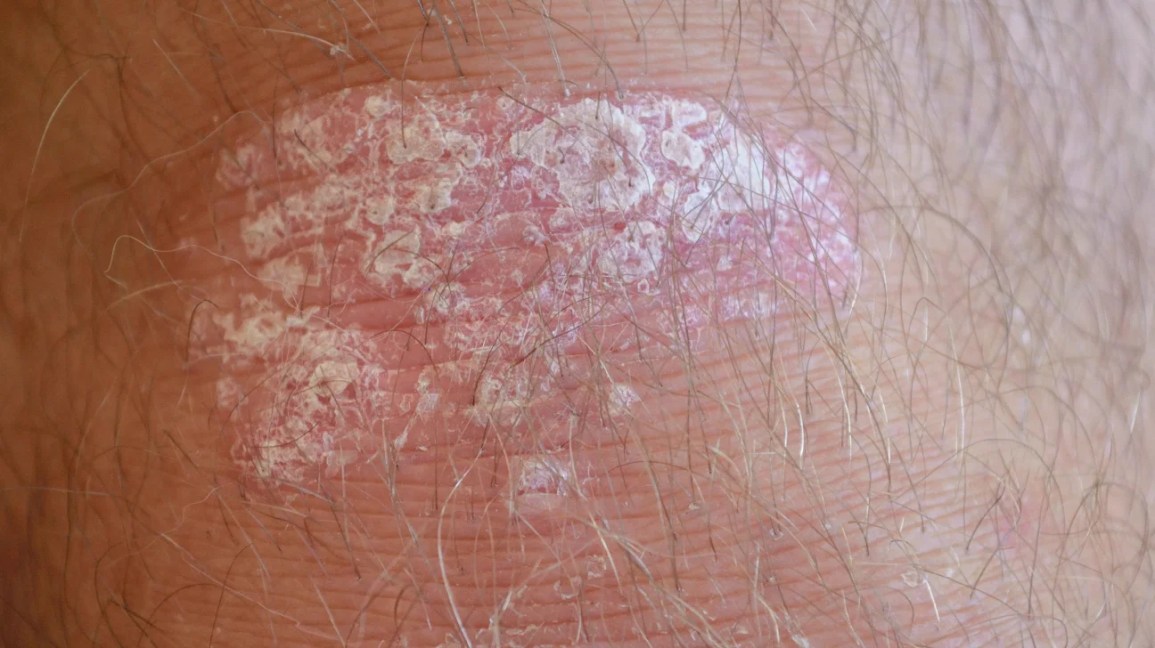 Dry Skin Patches Causes Symptoms And More