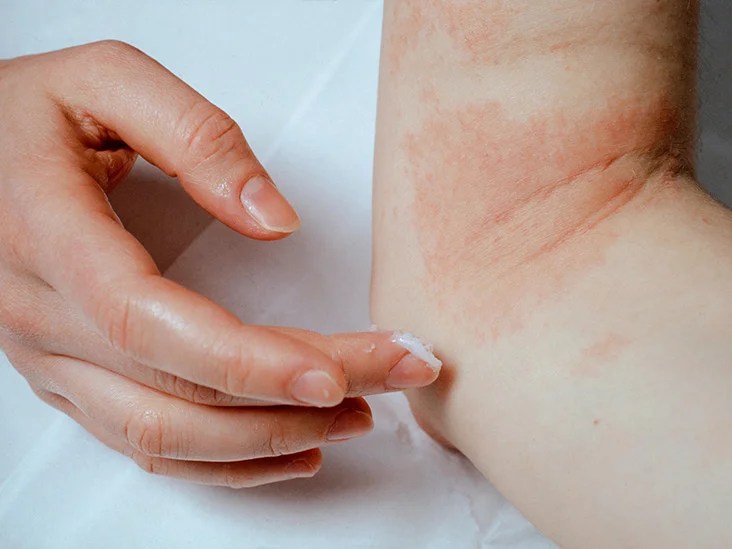 Eczema Síntomas Causas Y Tratamientos 2022