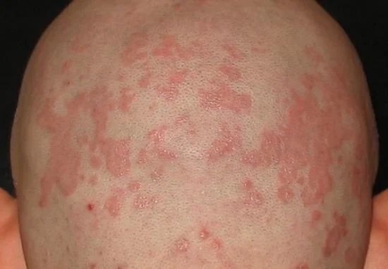 Dry Skin Patches Causes Symptoms Diagnosis And Treatments