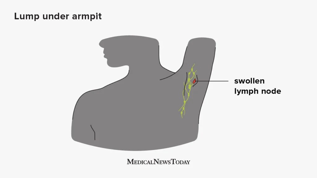 How To Cure Swollen Lymph Nodes Treatbeyond2