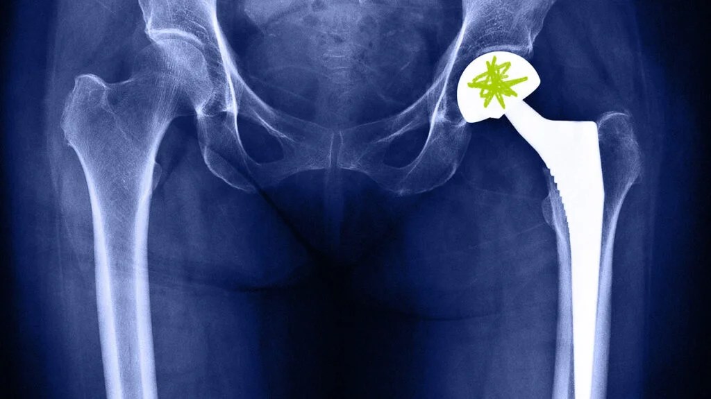 How To Avoid Hip Replacement Surgery Cousinyou14