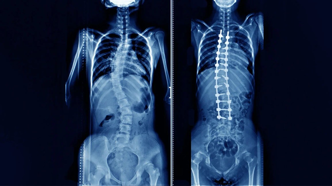 Scoliosis X Ray Before And After