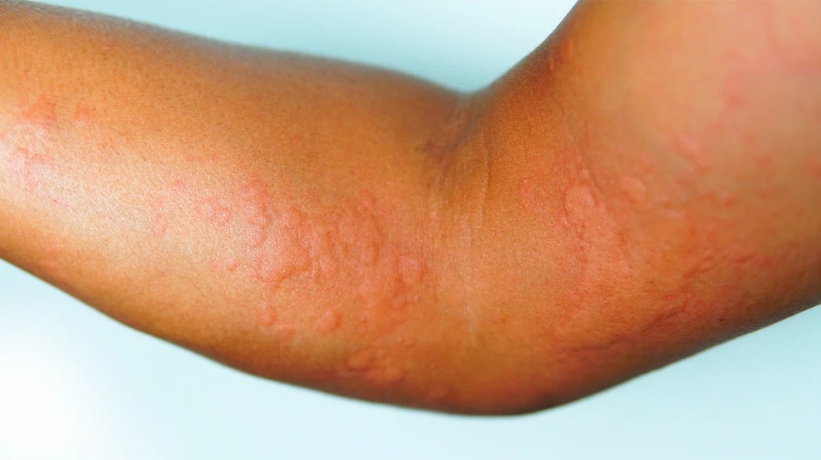 Common Skin Rashes And What To Do About Them 46 Off