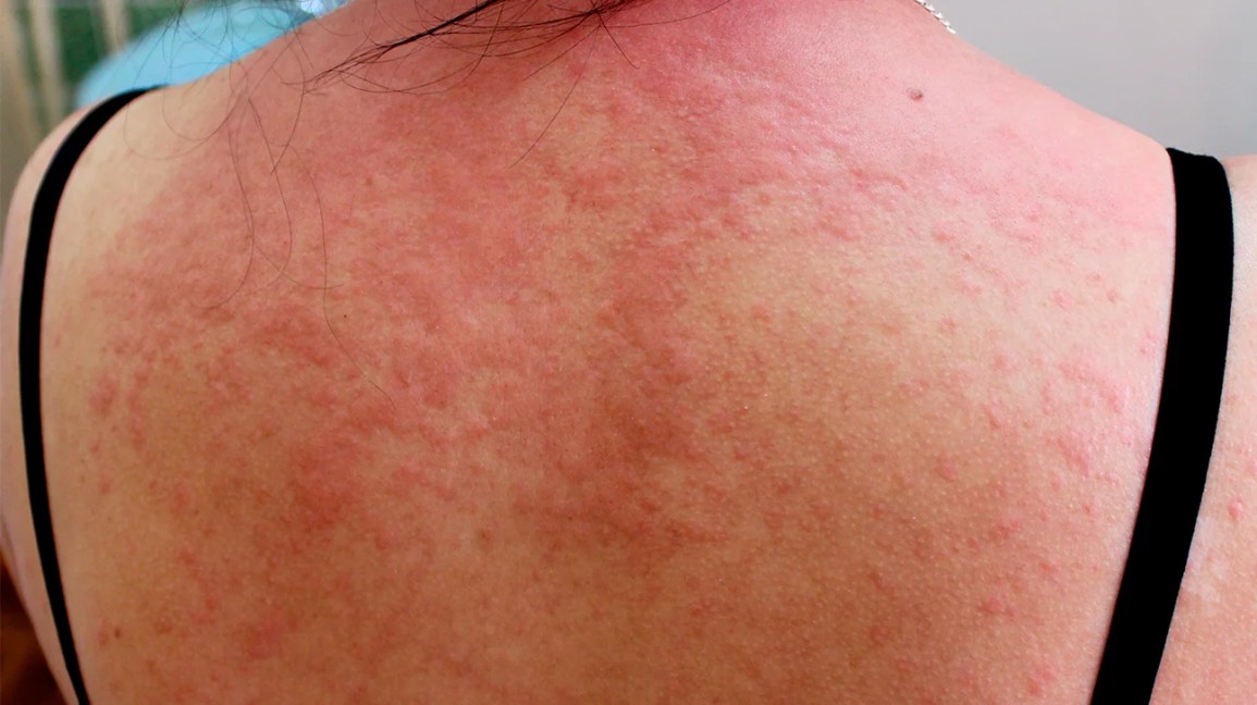 What Is The Treatment Of Skin Irritation