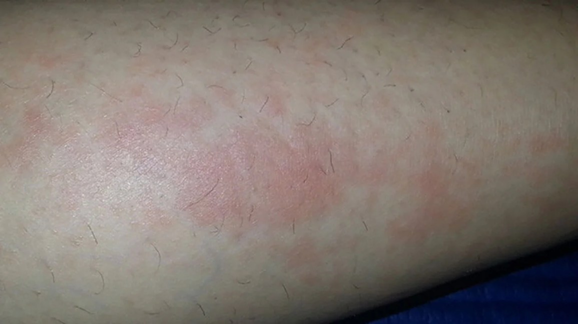 Itchy Skin Rash On Legs
