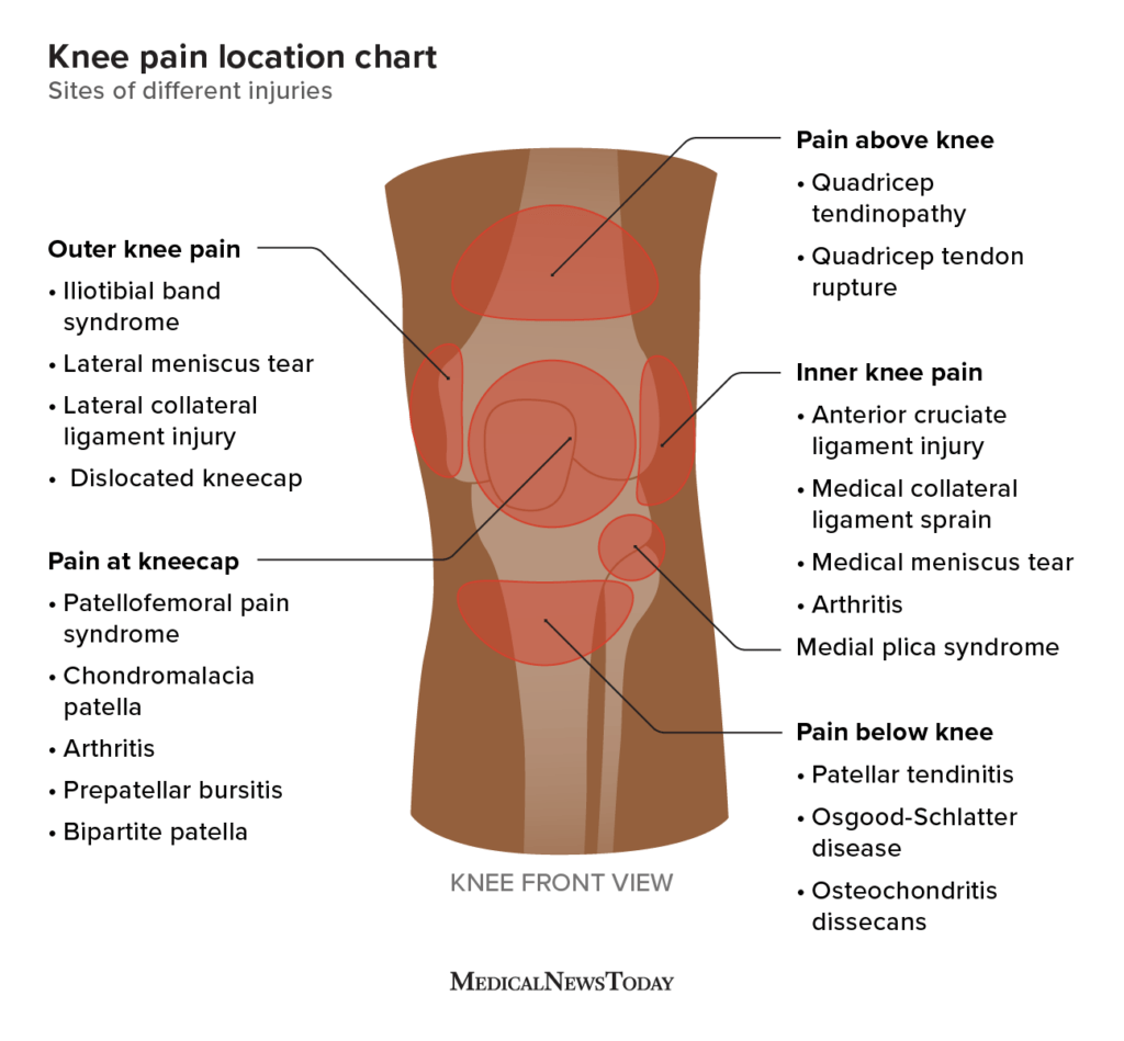 Knee Pain Diagnosis Chart