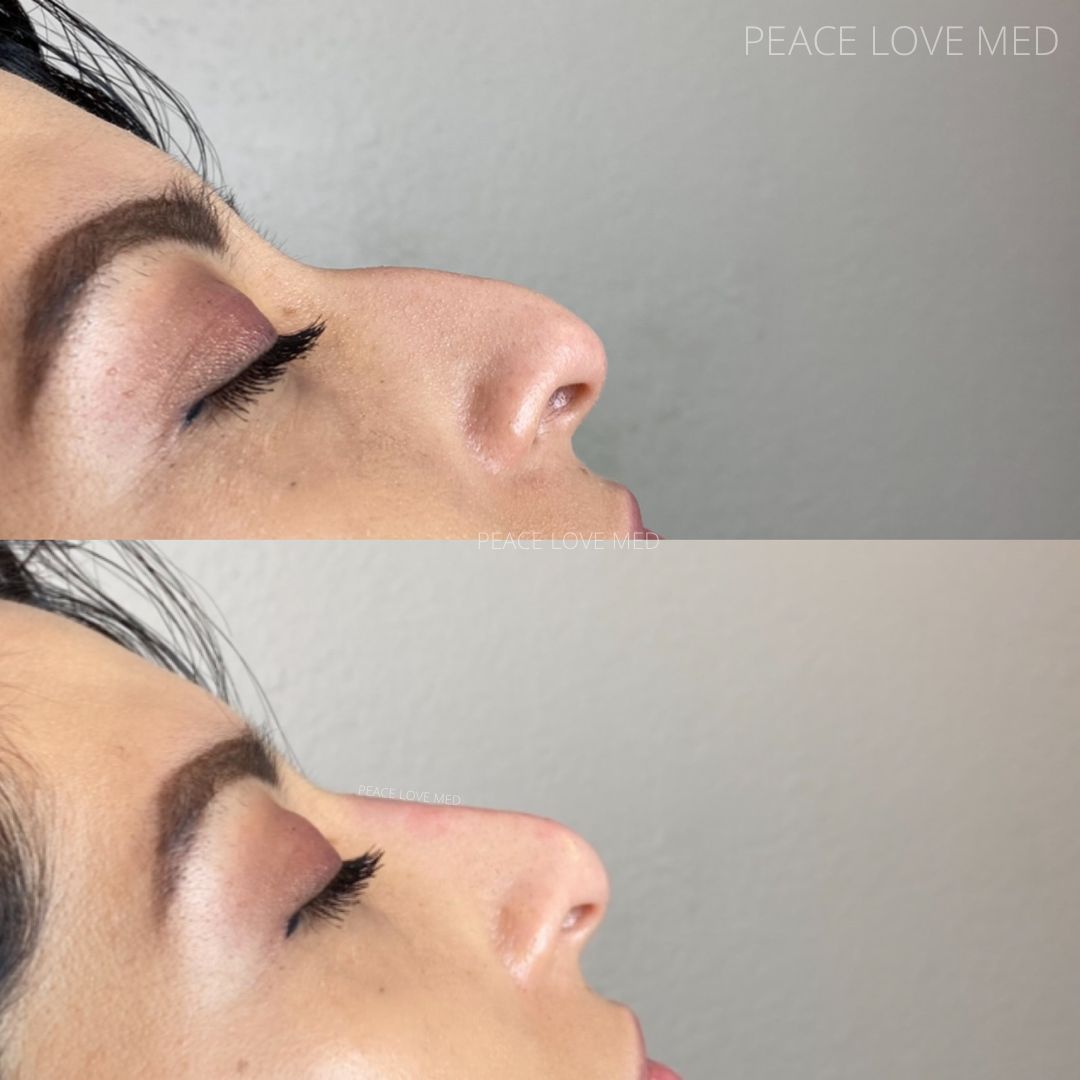 Non Surgical Nose Job Liquid Nose Job Boca Raton Thenosenurse