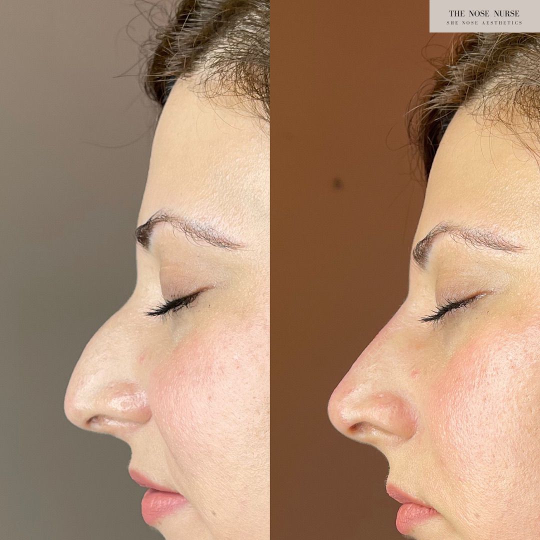 Non Surgical Nose Job Liquid Nose Job Boca Raton Thenosenurse